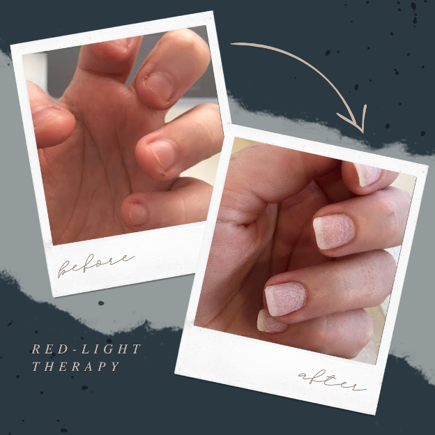 Can Poly Red Light Therapy Boost Nail Growth?